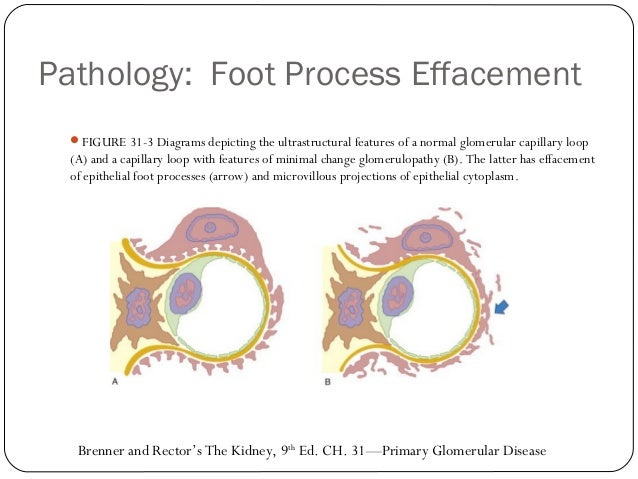 Minimal Change Disease