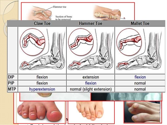 MCE 2016, semester ii, foot deformities, Benha University Orthopaedi…