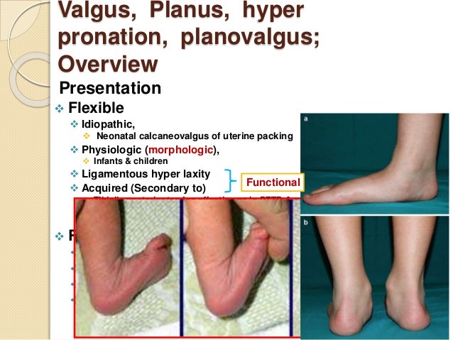 MCE 2016, semester ii, foot deformities, Benha University Orthopaedi…