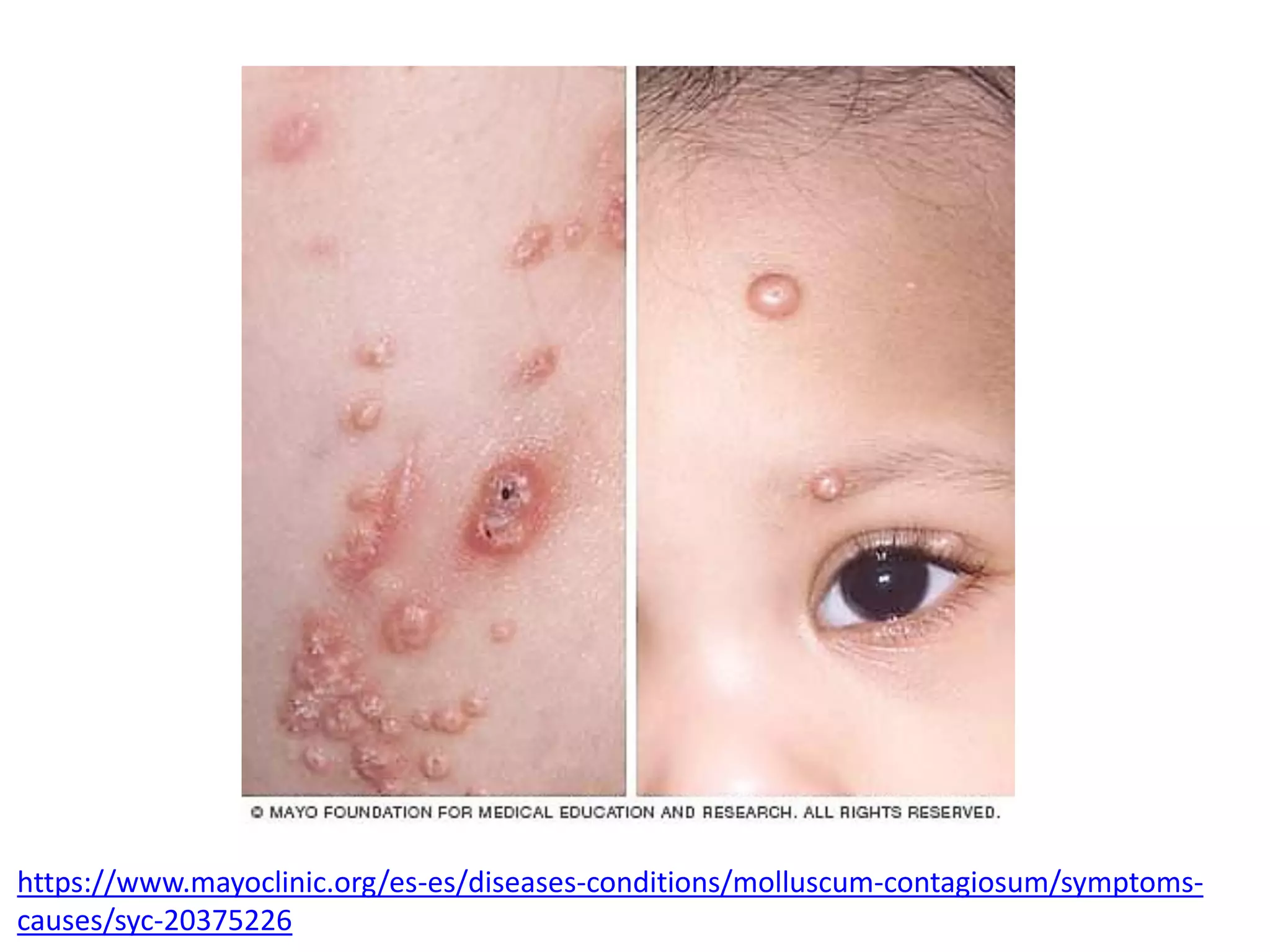 Virus del molusco contagioso | PPT