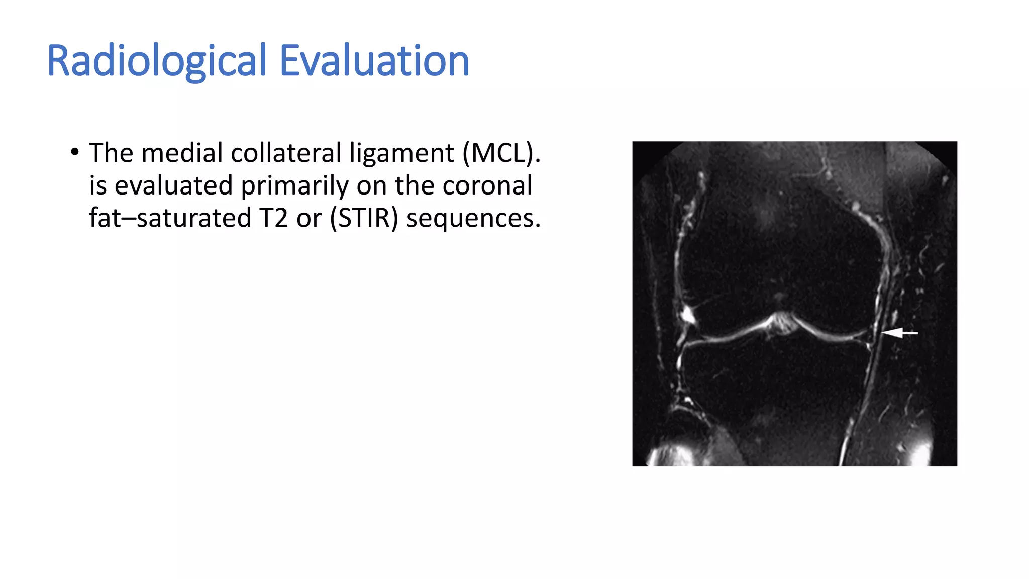 MCL,LCL & ALL injuries of the knee | PDF