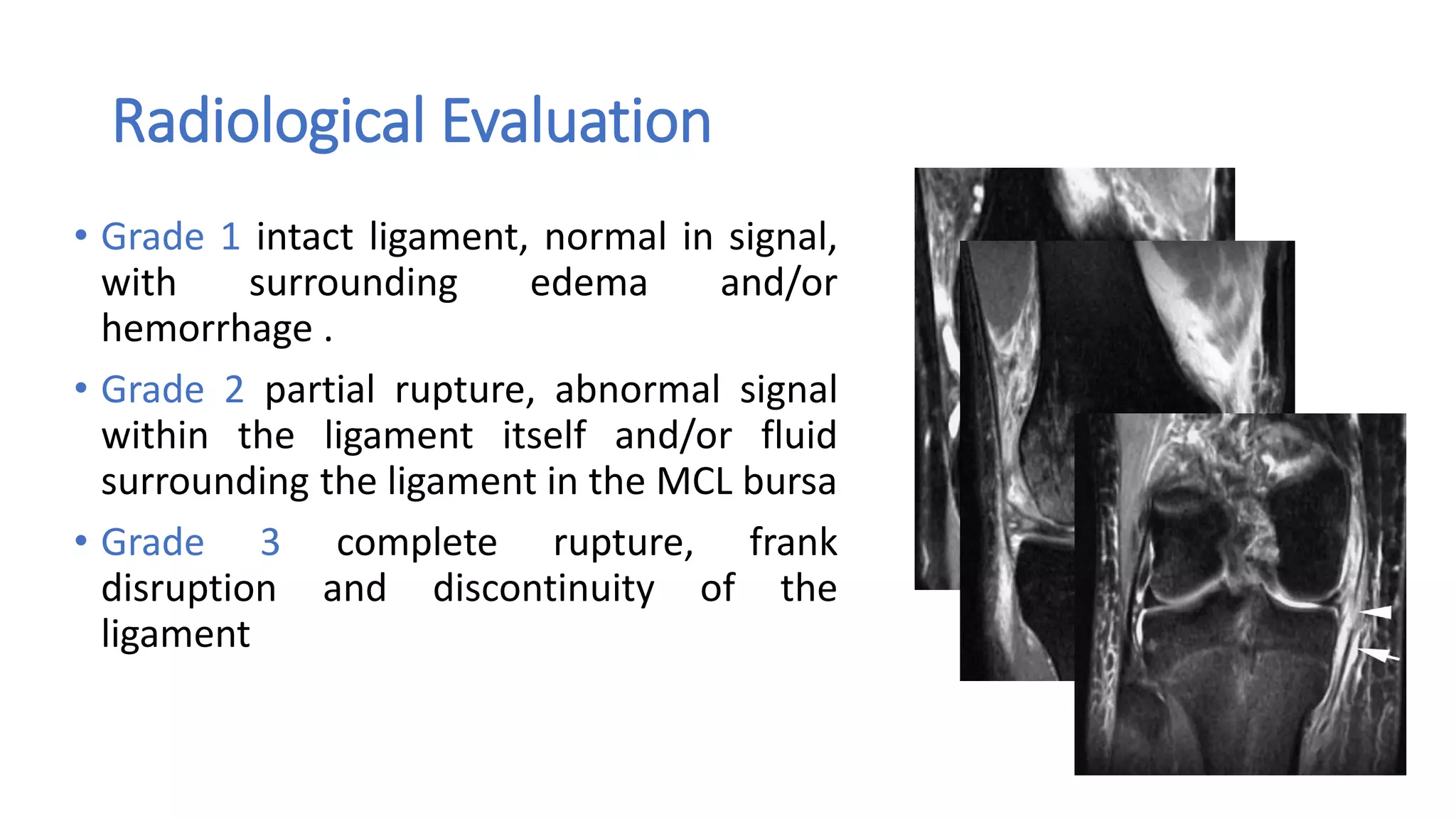 MCL,LCL & ALL injuries of the knee | PDF