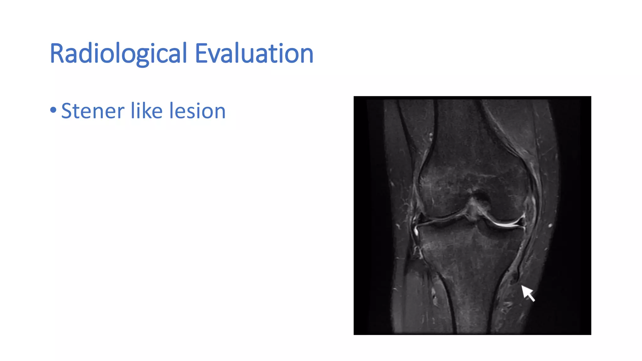 MCL,LCL & ALL injuries of the knee | PDF