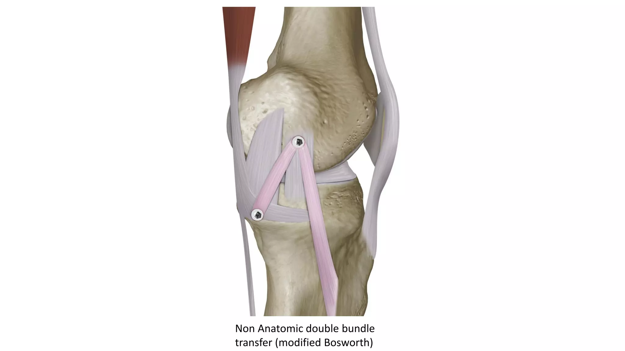 MCL,LCL & ALL injuries of the knee | PDF