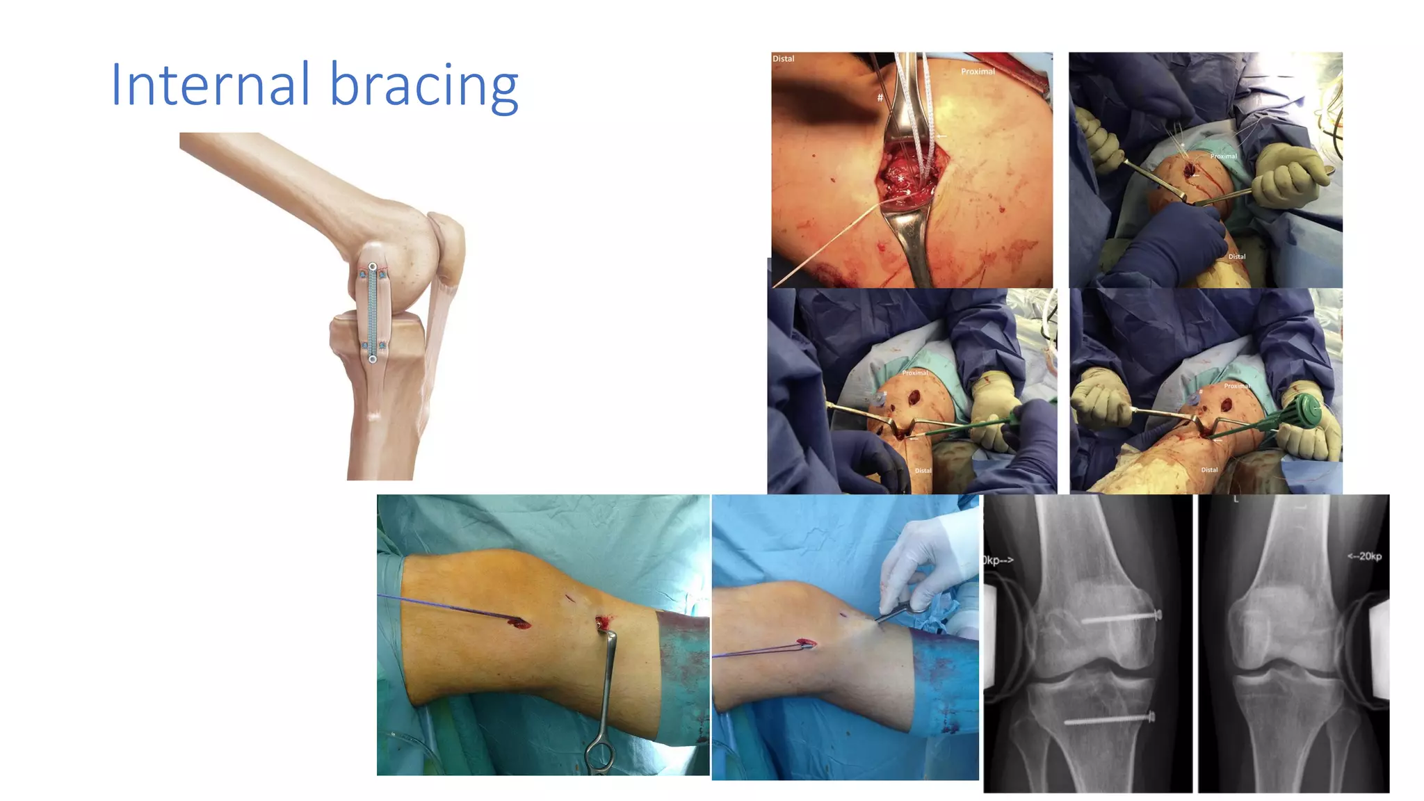 MCL,LCL & ALL injuries of the knee | PDF