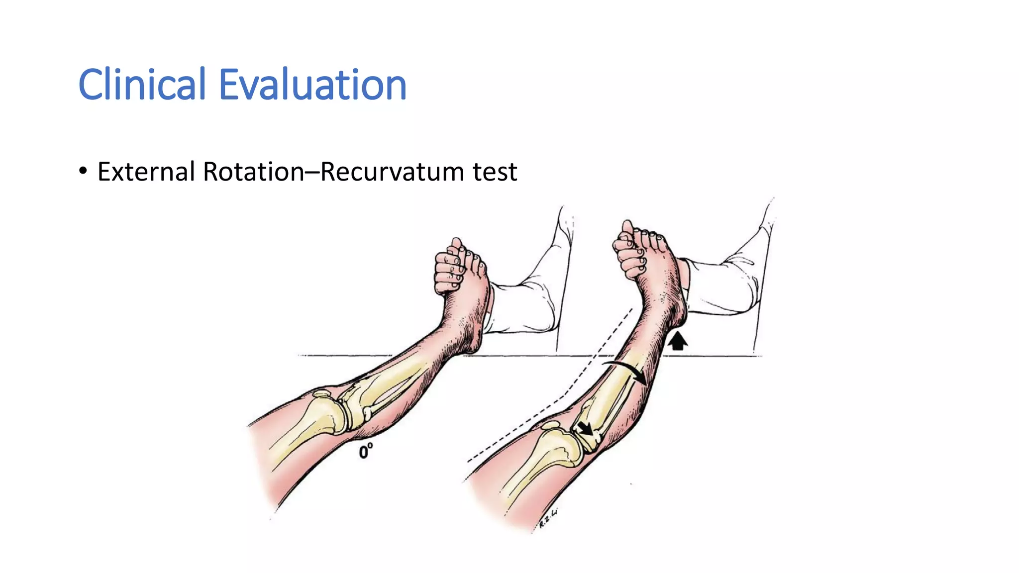 MCL,LCL & ALL injuries of the knee | PDF