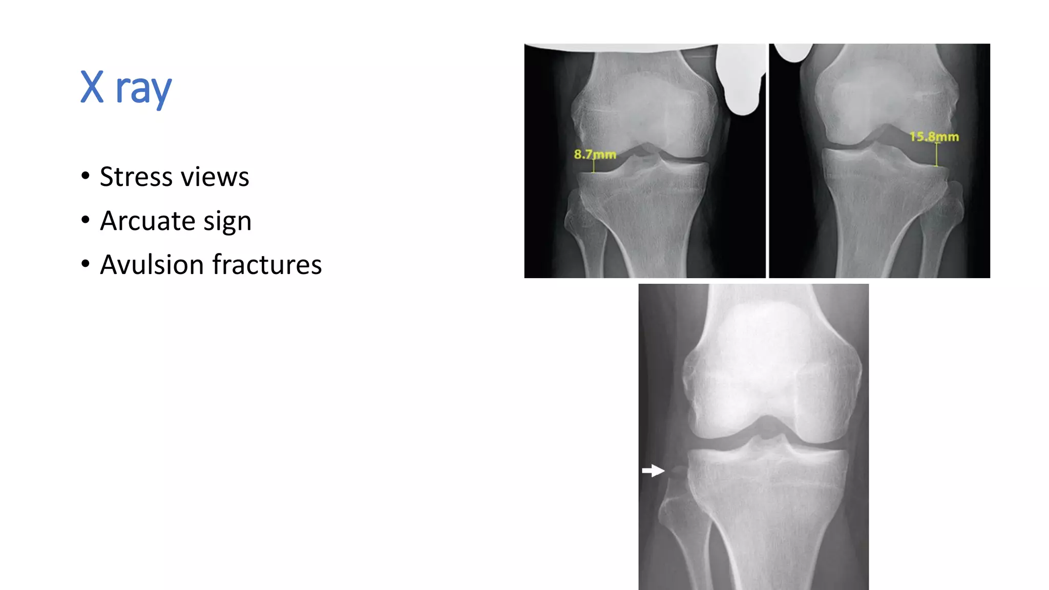 MCL,LCL & ALL injuries of the knee | PDF
