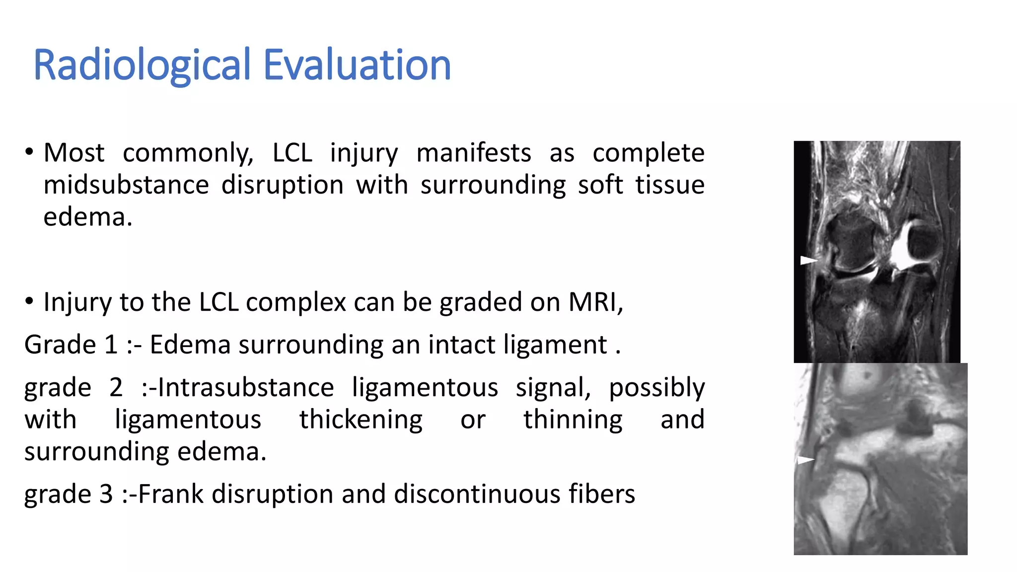 MCL,LCL & ALL injuries of the knee | PDF