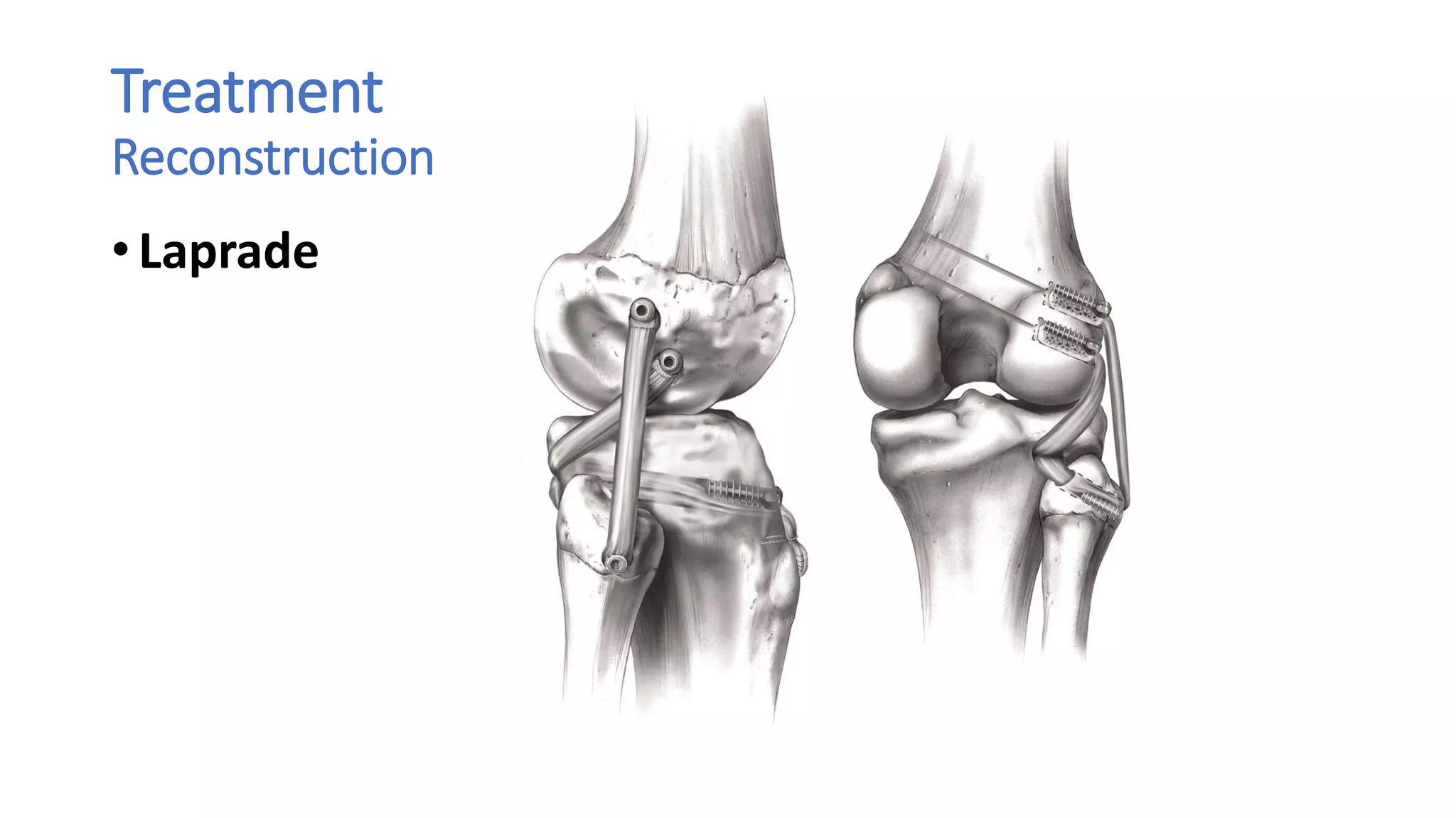 MCL,LCL & ALL injuries of the knee | PDF