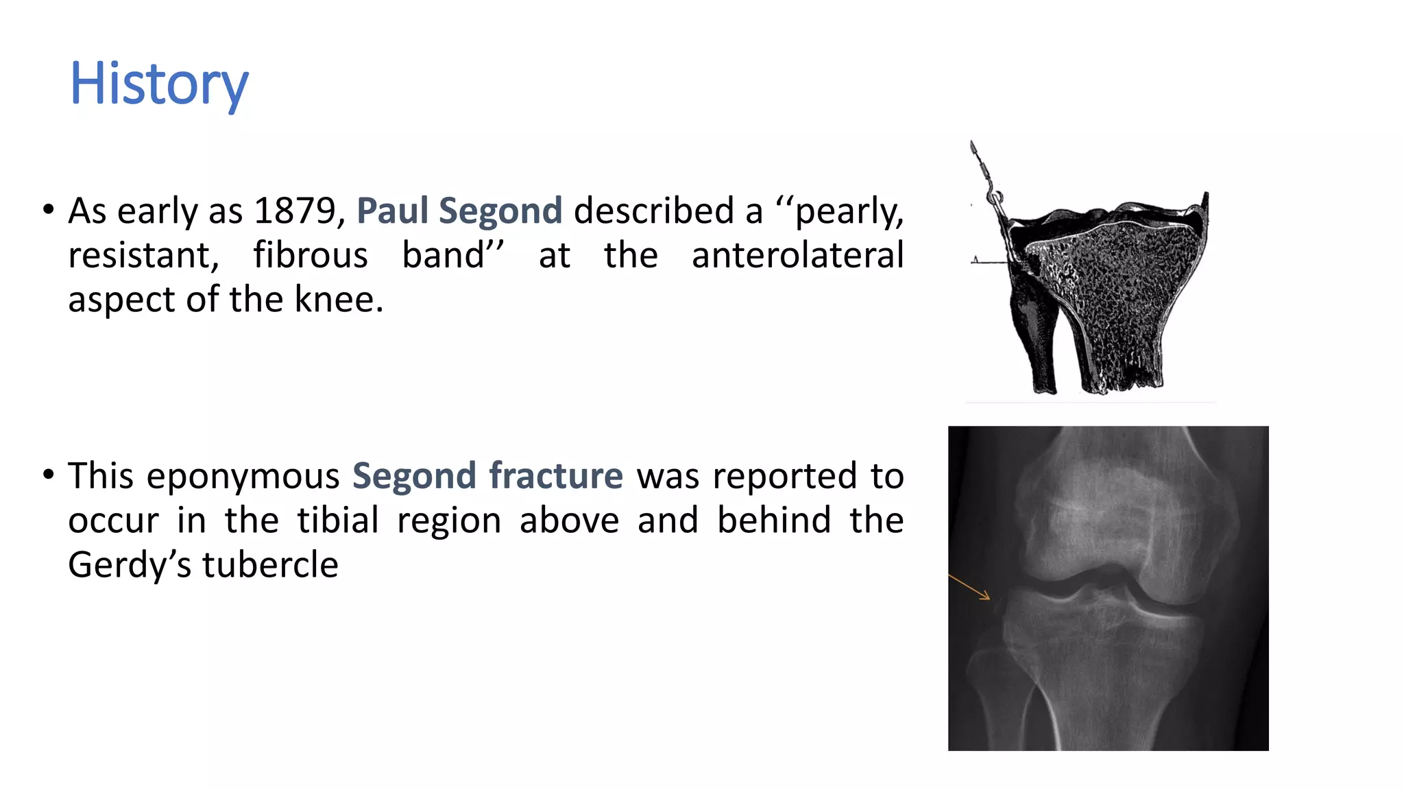 MCL,LCL & ALL injuries of the knee | PDF