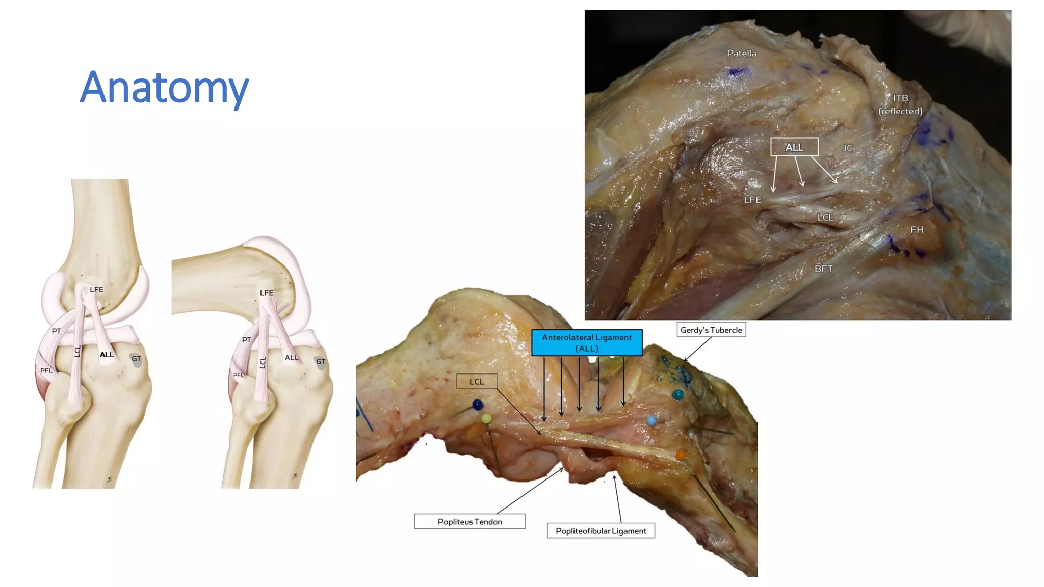 MCL,LCL & ALL injuries of the knee | PDF