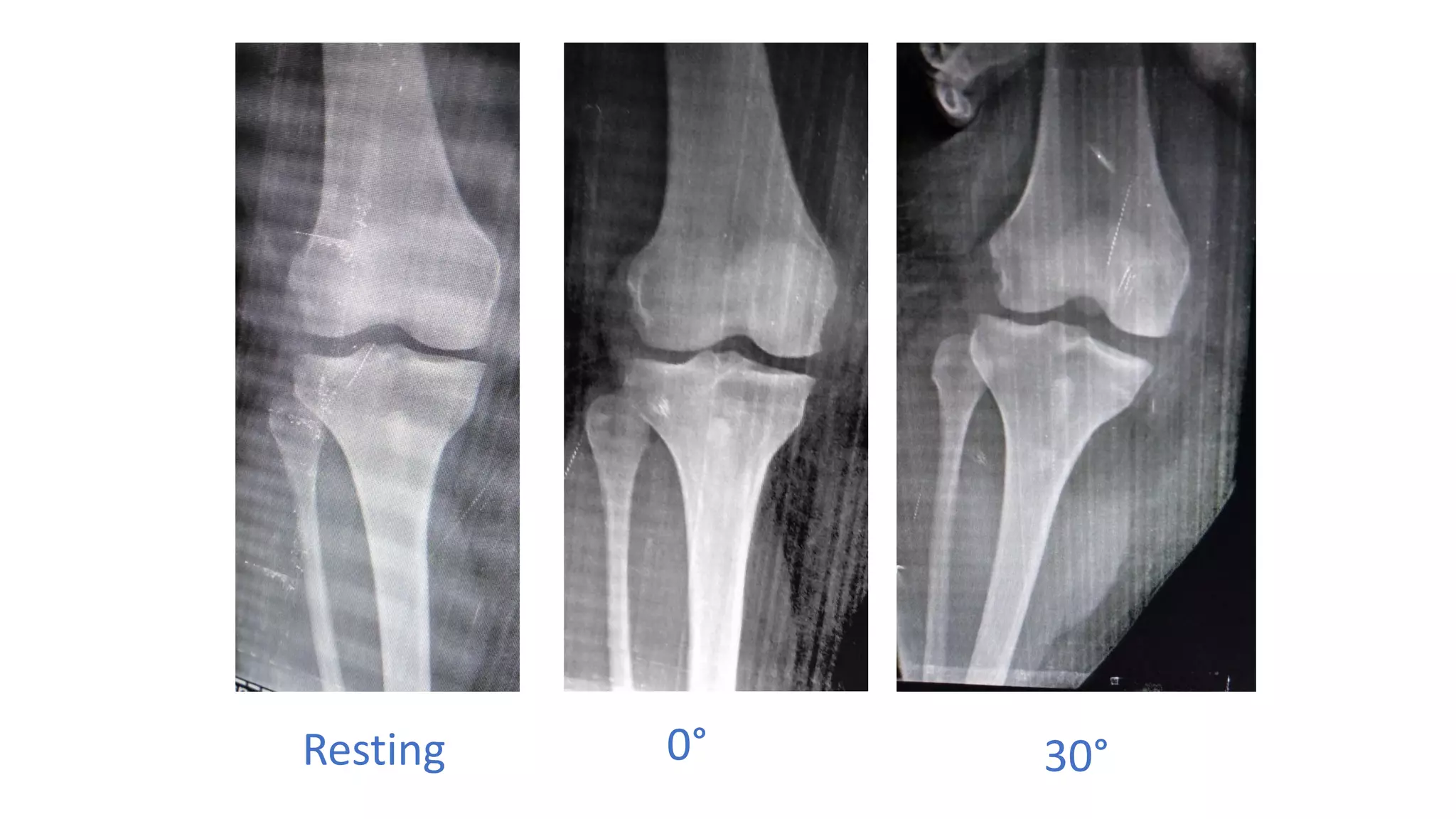 MCL,LCL & ALL injuries of the knee | PDF