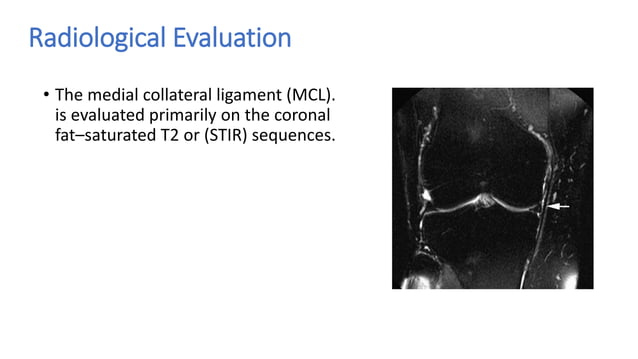 MCL,LCL & ALL injuries of the knee | PDF