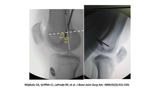 MCL,LCL & ALL injuries of the knee | PDF