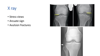 MCL,LCL & ALL injuries of the knee | PDF