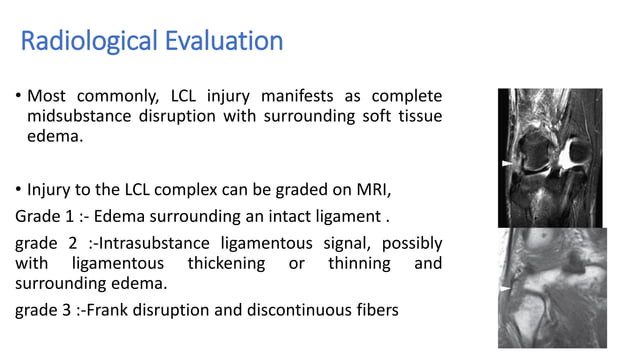 MCL,LCL & ALL injuries of the knee | PDF