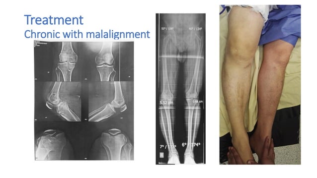 MCL,LCL & ALL injuries of the knee | PDF
