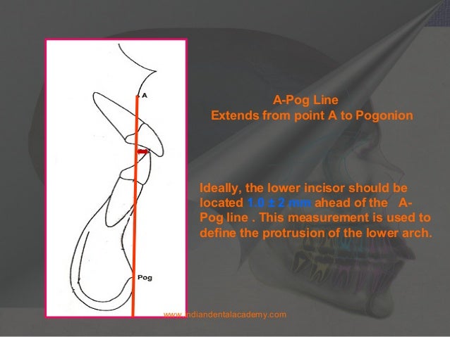 Mc namara analysis /certified fixed orthodontic courses by Indian den…