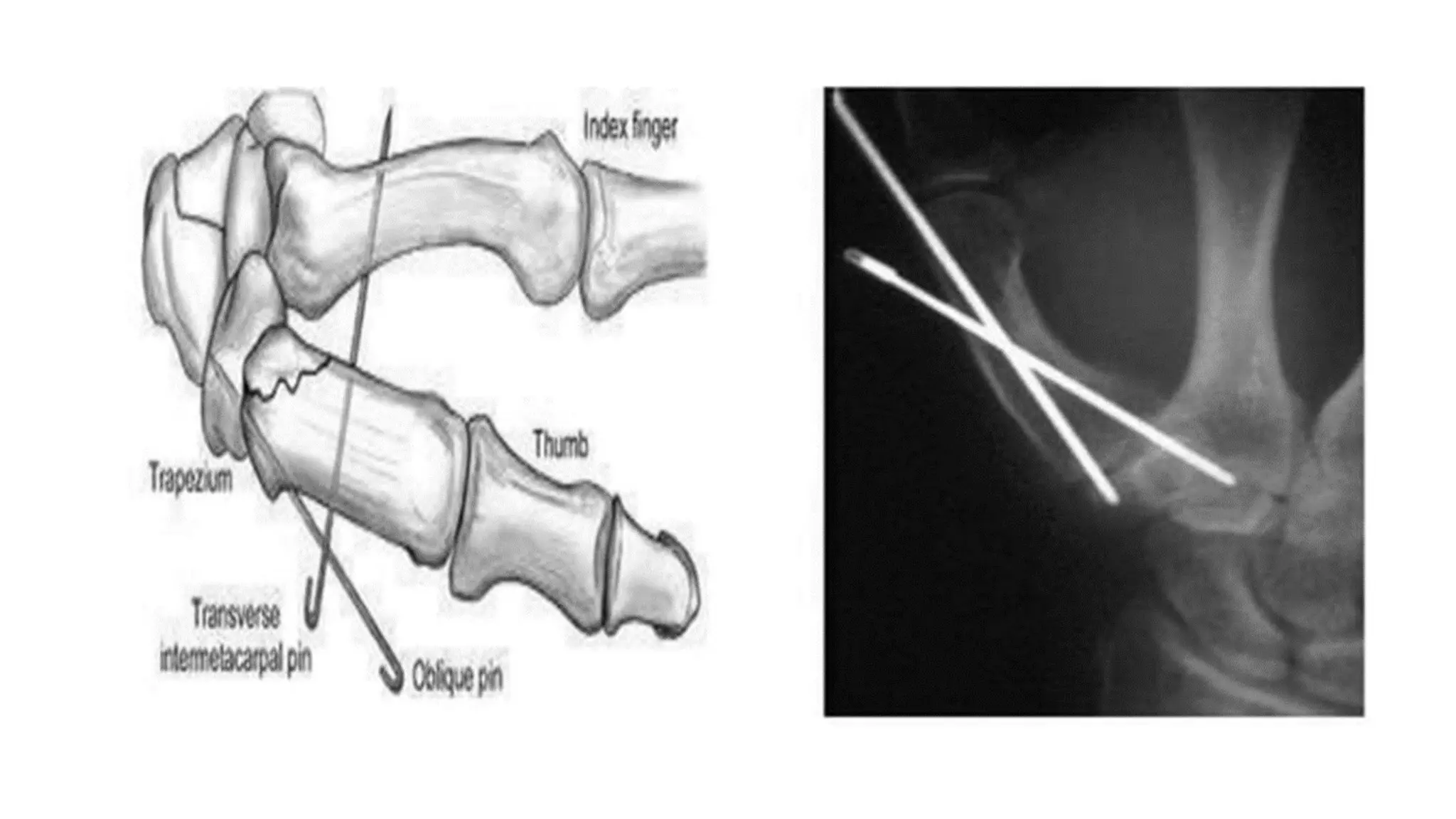 mc,phalanges fractures.pptxkaplansdislocation | PPTX