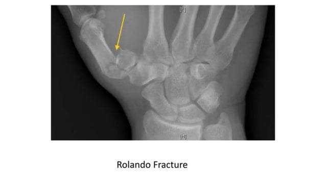 mc,phalanges fractures.pptxkaplansdislocation | PPT