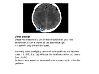 MCQ Chall_Gr_CVST cerebral venous thrombosis .pptx