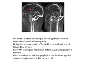 MCQ Chall_Gr_CVST cerebral venous thrombosis .pptx
