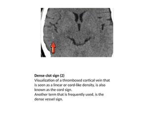 MCQ Chall_Gr_CVST cerebral venous thrombosis .pptx