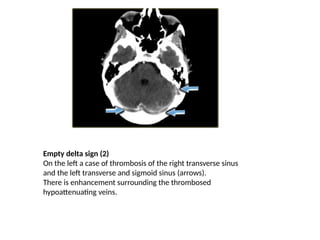 MCQ Chall_Gr_CVST cerebral venous thrombosis .pptx