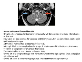MCQ Chall_Gr_CVST cerebral venous thrombosis .pptx