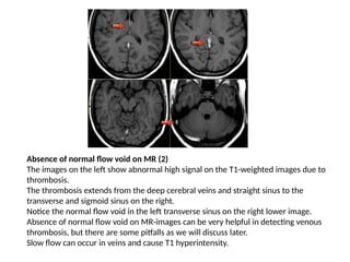 MCQ Chall_Gr_CVST cerebral venous thrombosis .pptx