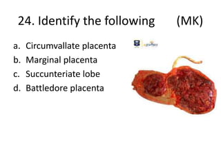 MCQs - Specimens in Obstetrics and Gynaecology | PPTX