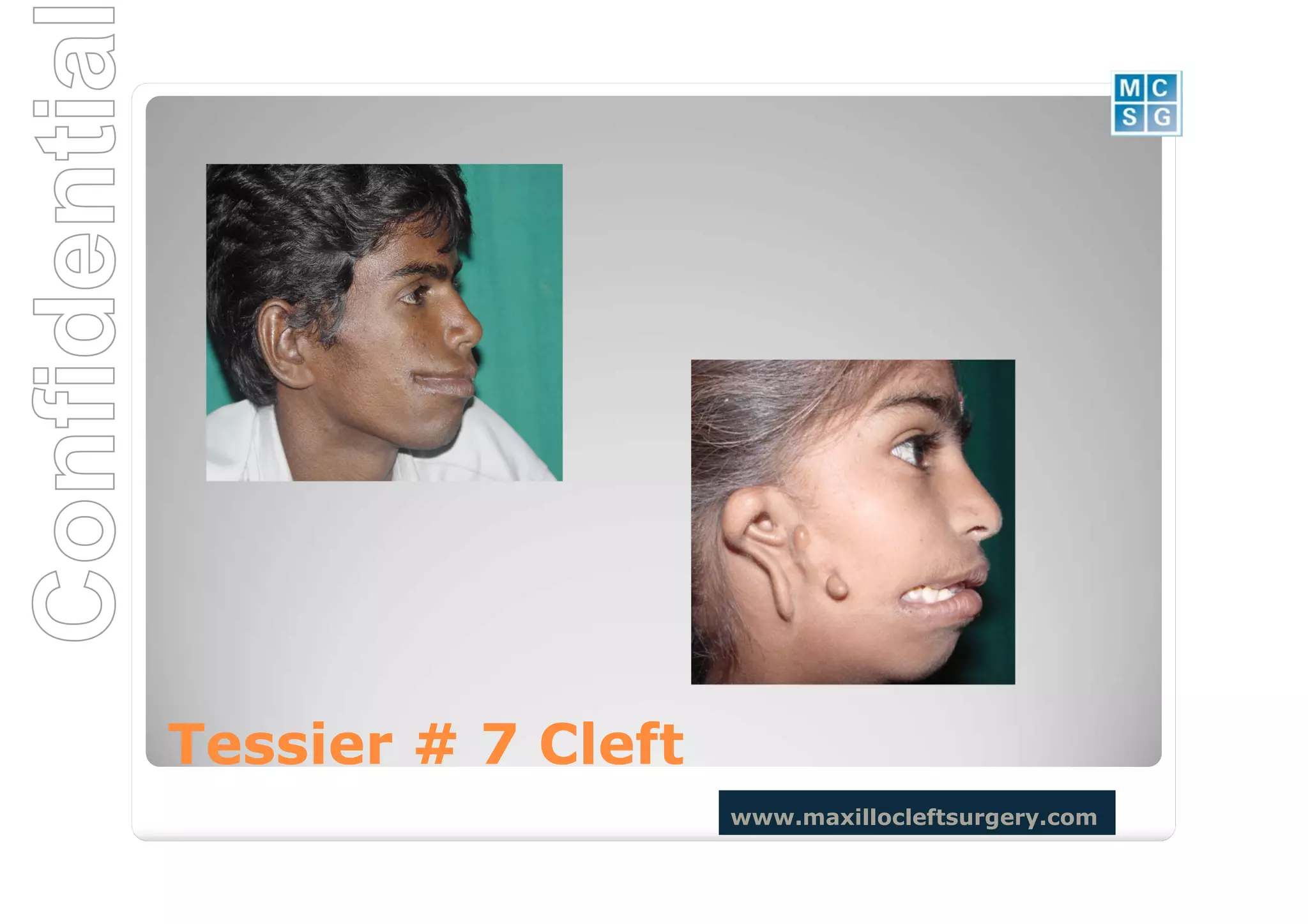Cleft Lip and Palate Surgery | PDF