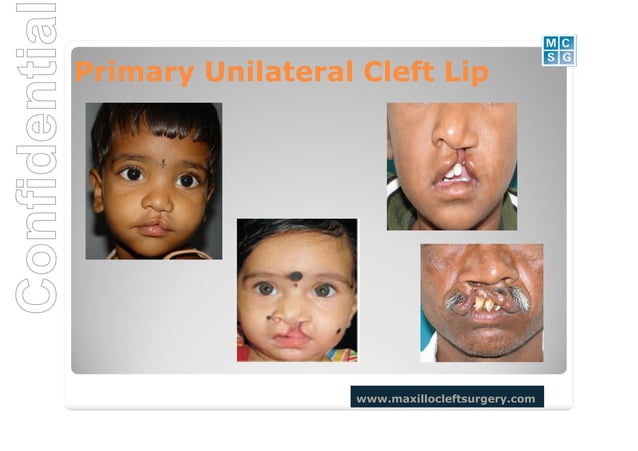 Cleft Lip and Palate Surgery | PPT