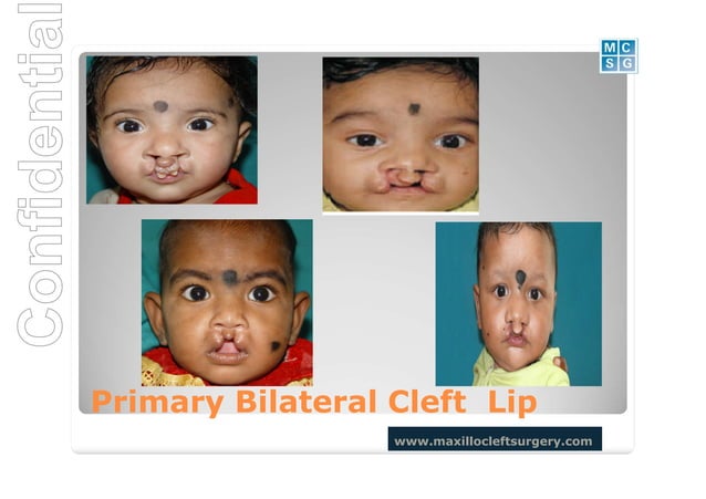 Cleft Lip and Palate Surgery | PPT