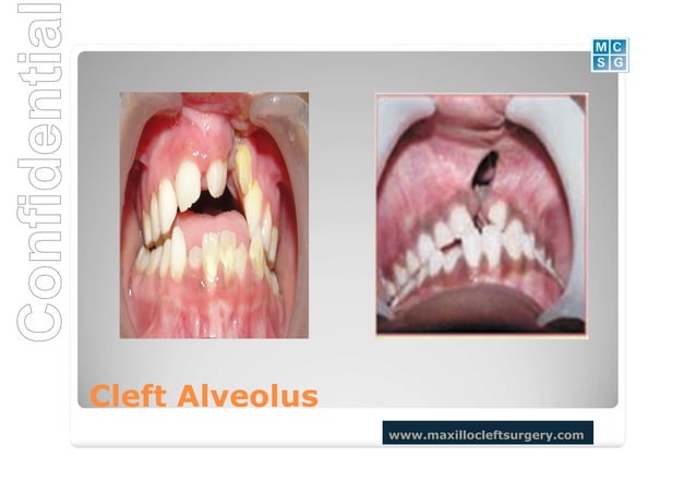 Cleft Lip and Palate Surgery | PPT