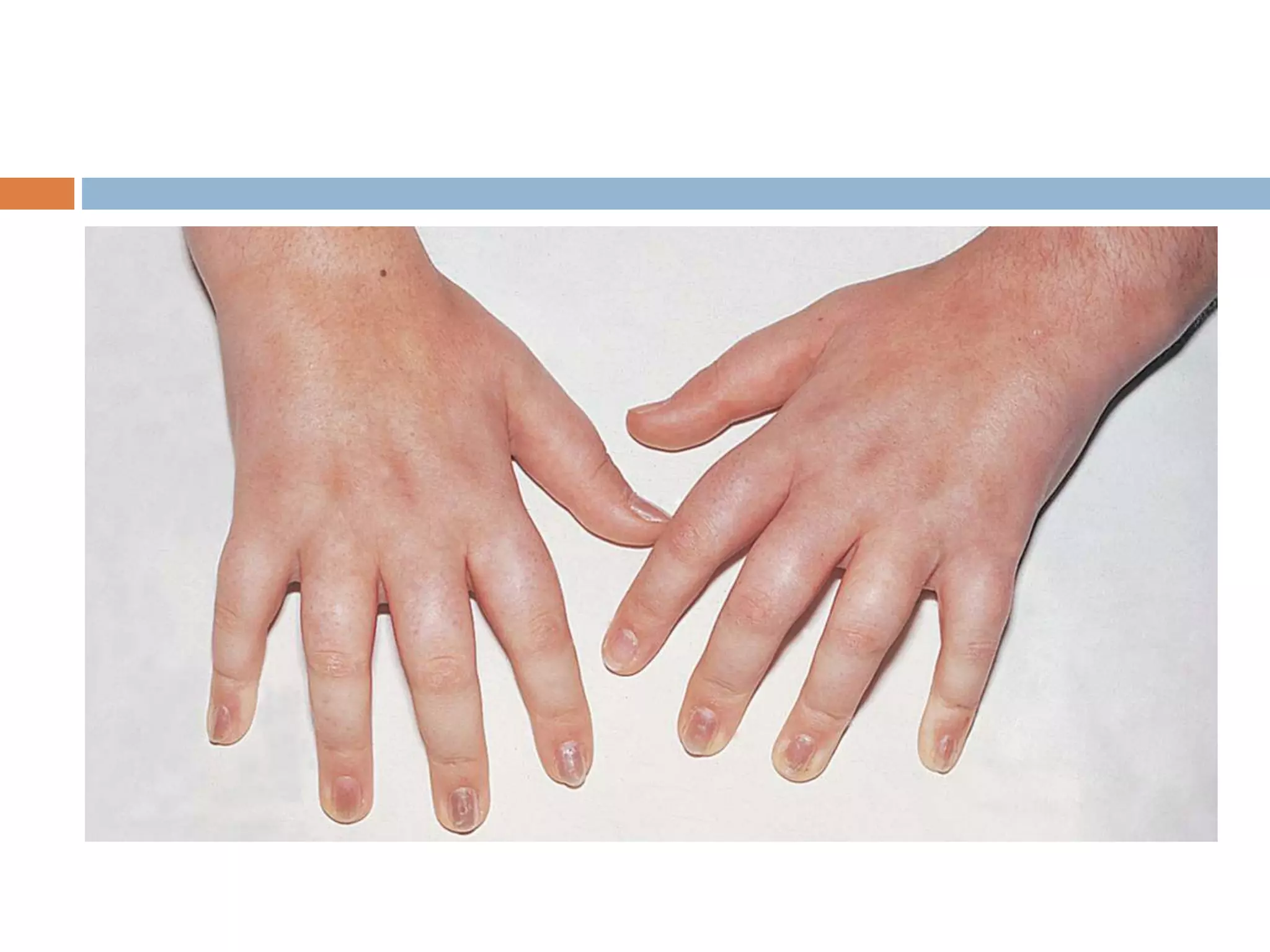 Mixed connective tissue disorder | PPTX