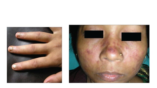 MCTD its introduction and further classification,according to criteria ...