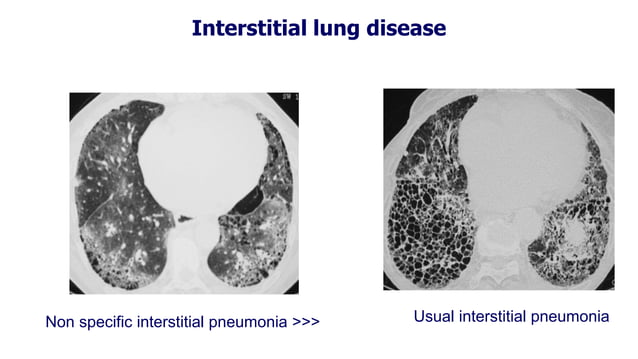 MCTD its introduction and further classification,according to criteria ...