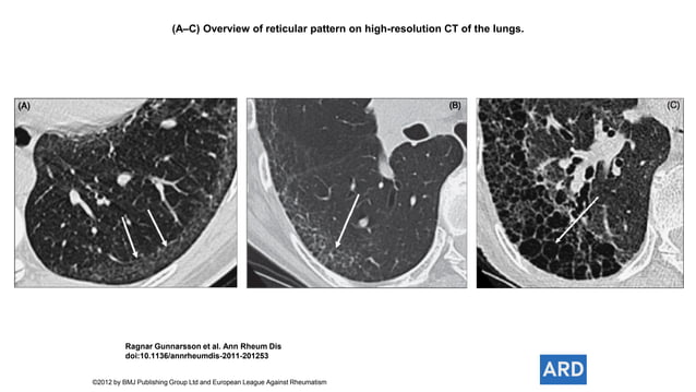 MCTD its introduction and further classification,according to criteria ...