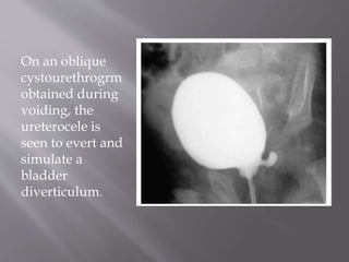 Voiding cystourethrogram used in Diagnostic Radiology | PPT