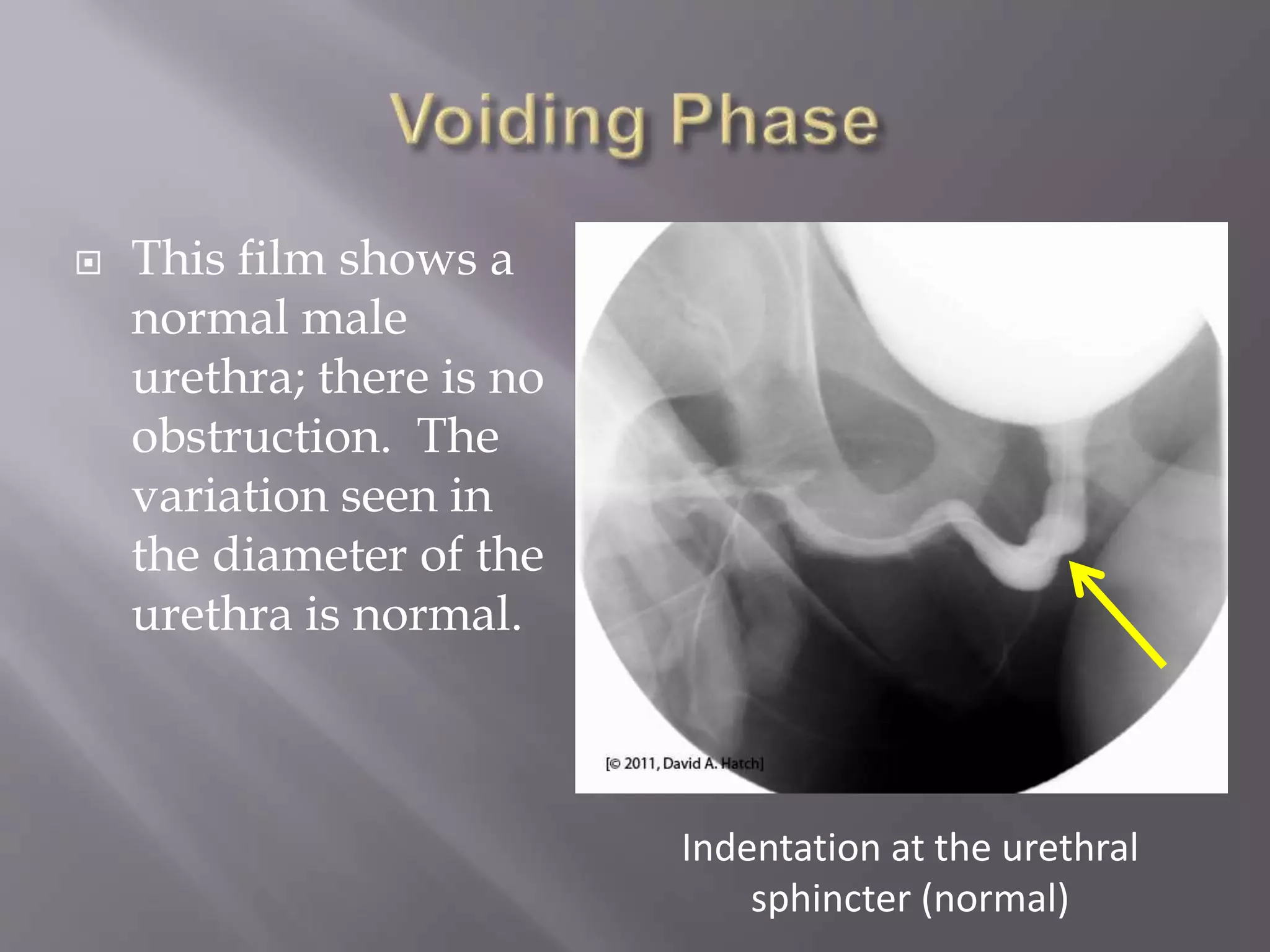 MCU- Micturating cysto-urethrogram | PPTX