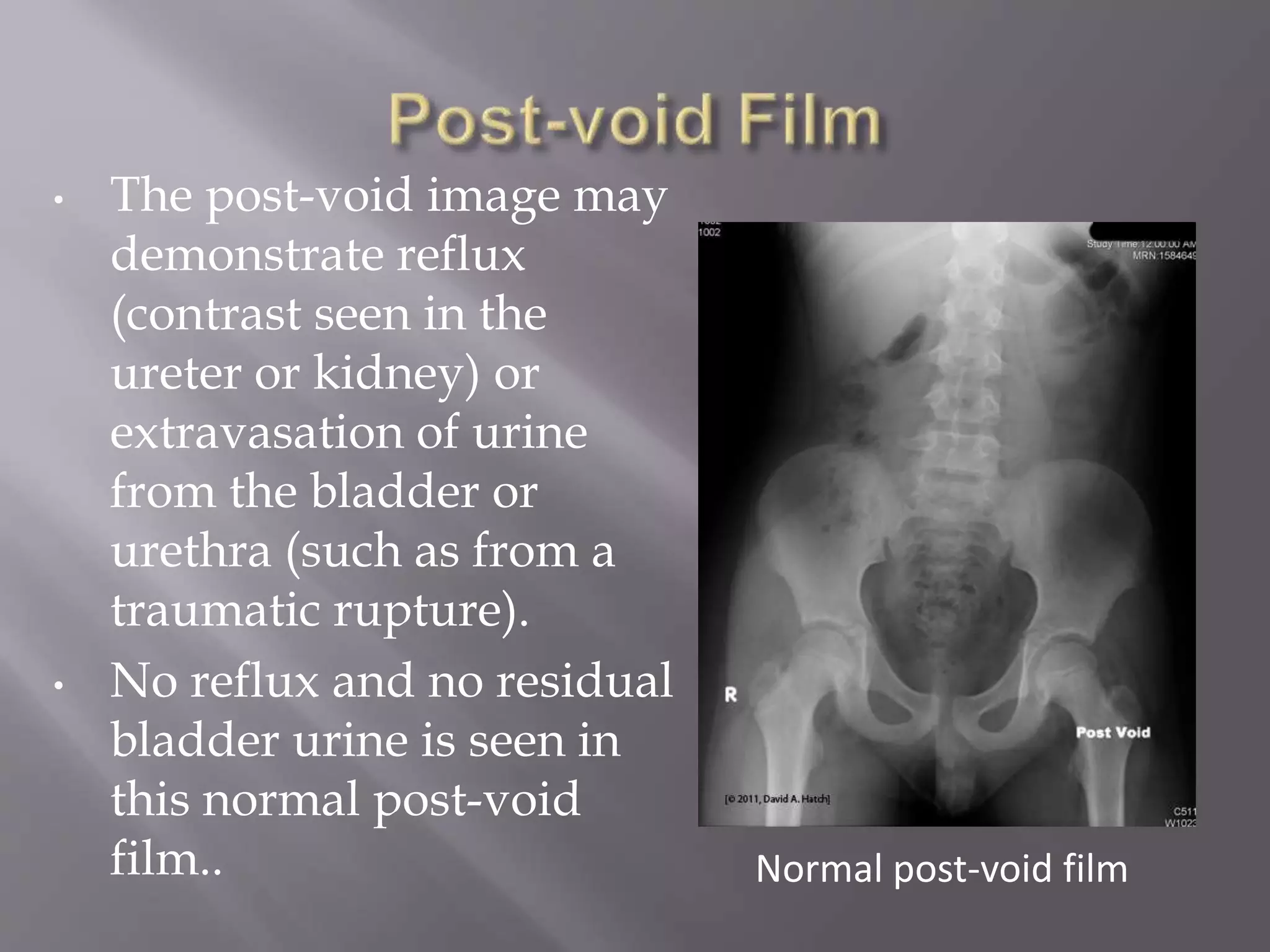 MCU- Micturating cysto-urethrogram | PPTX