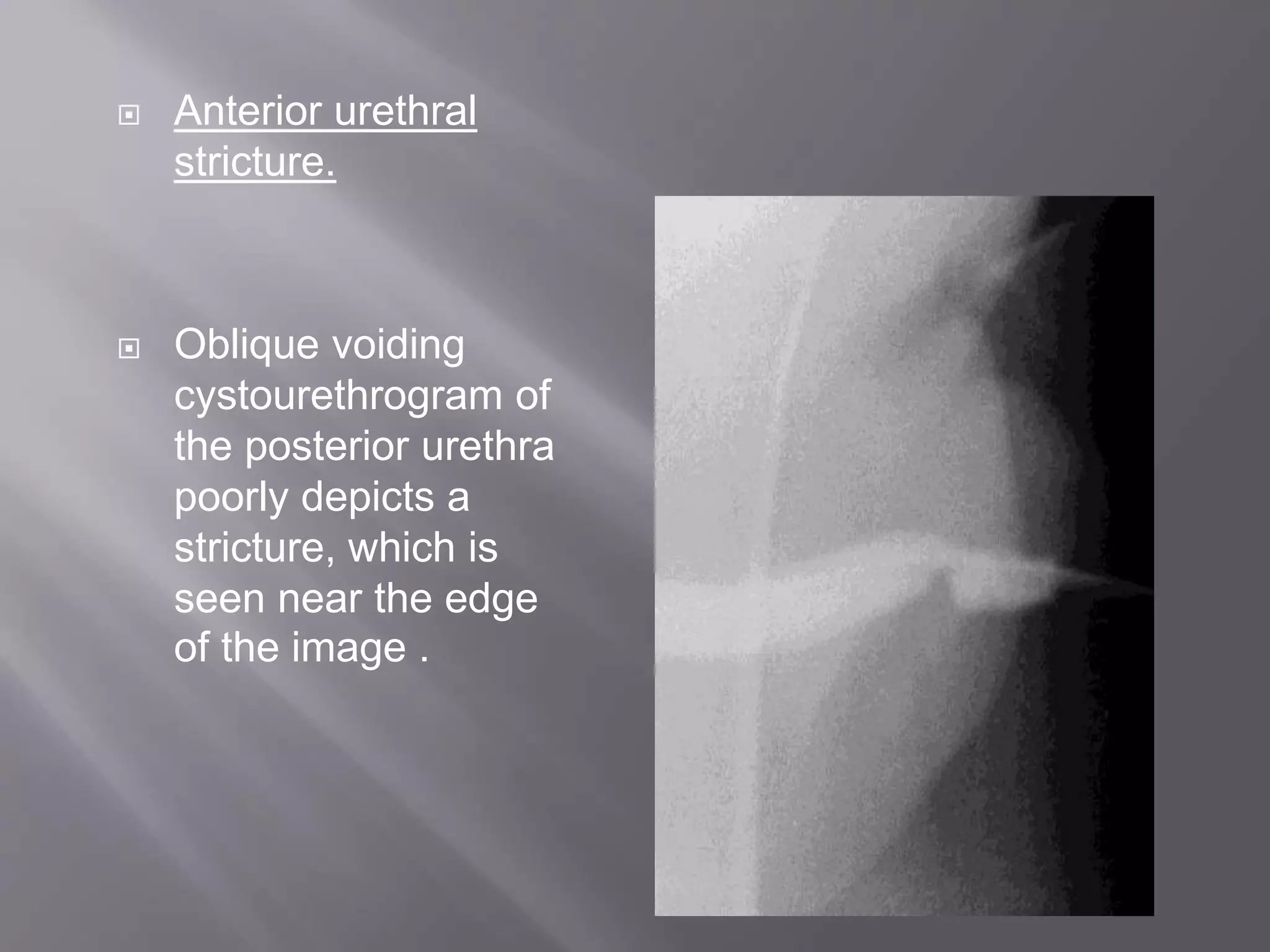 MCU- Micturating cysto-urethrogram | PPTX
