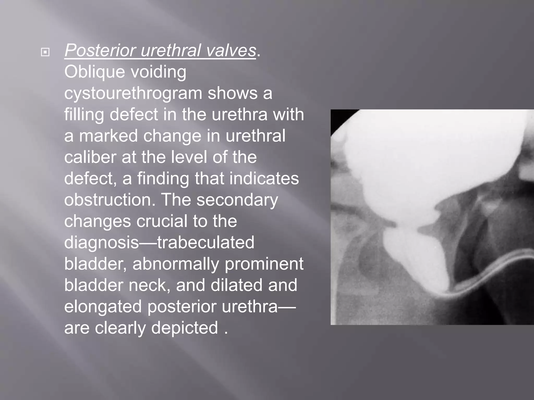 MCU- Micturating cysto-urethrogram | PPTX