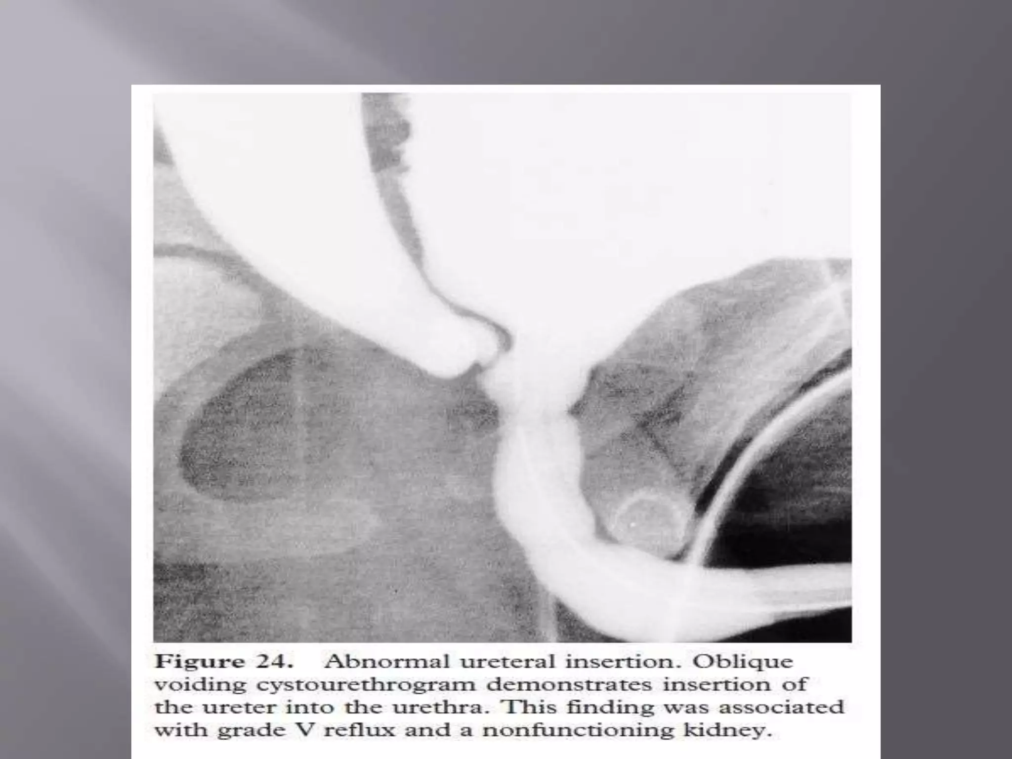 MCU- Micturating cysto-urethrogram | PPTX
