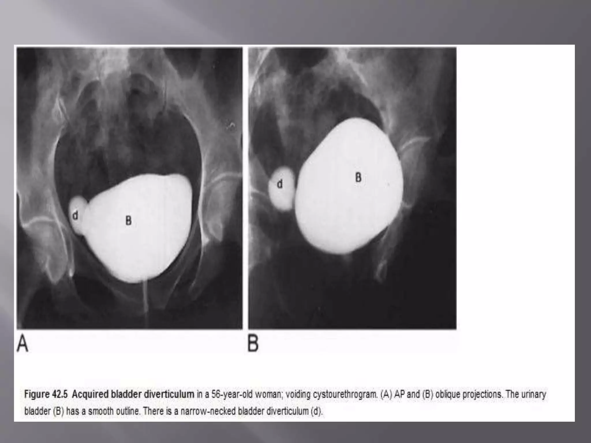 MCU- Micturating cysto-urethrogram | PPTX