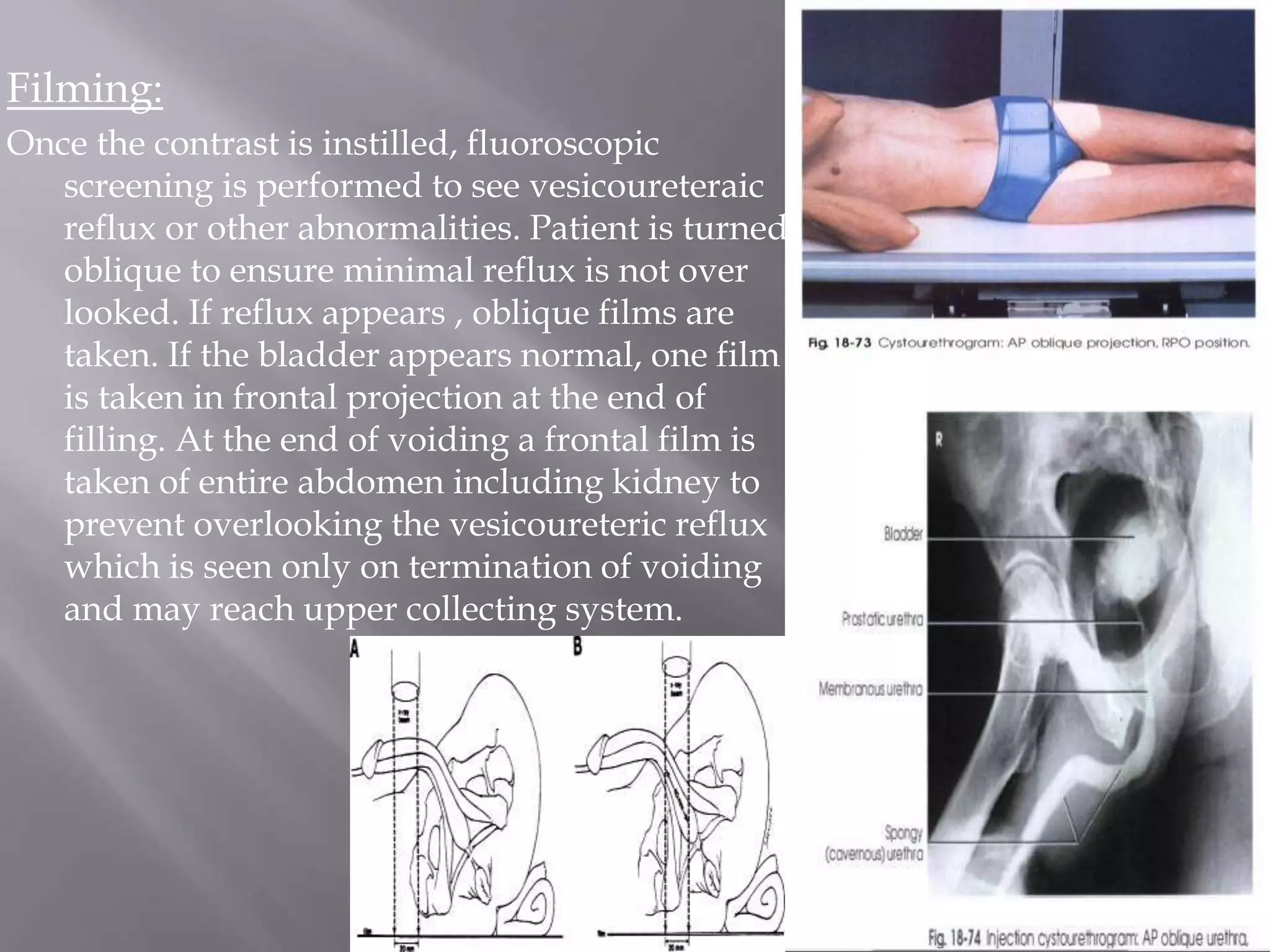 MCU- Micturating cysto-urethrogram | PPTX