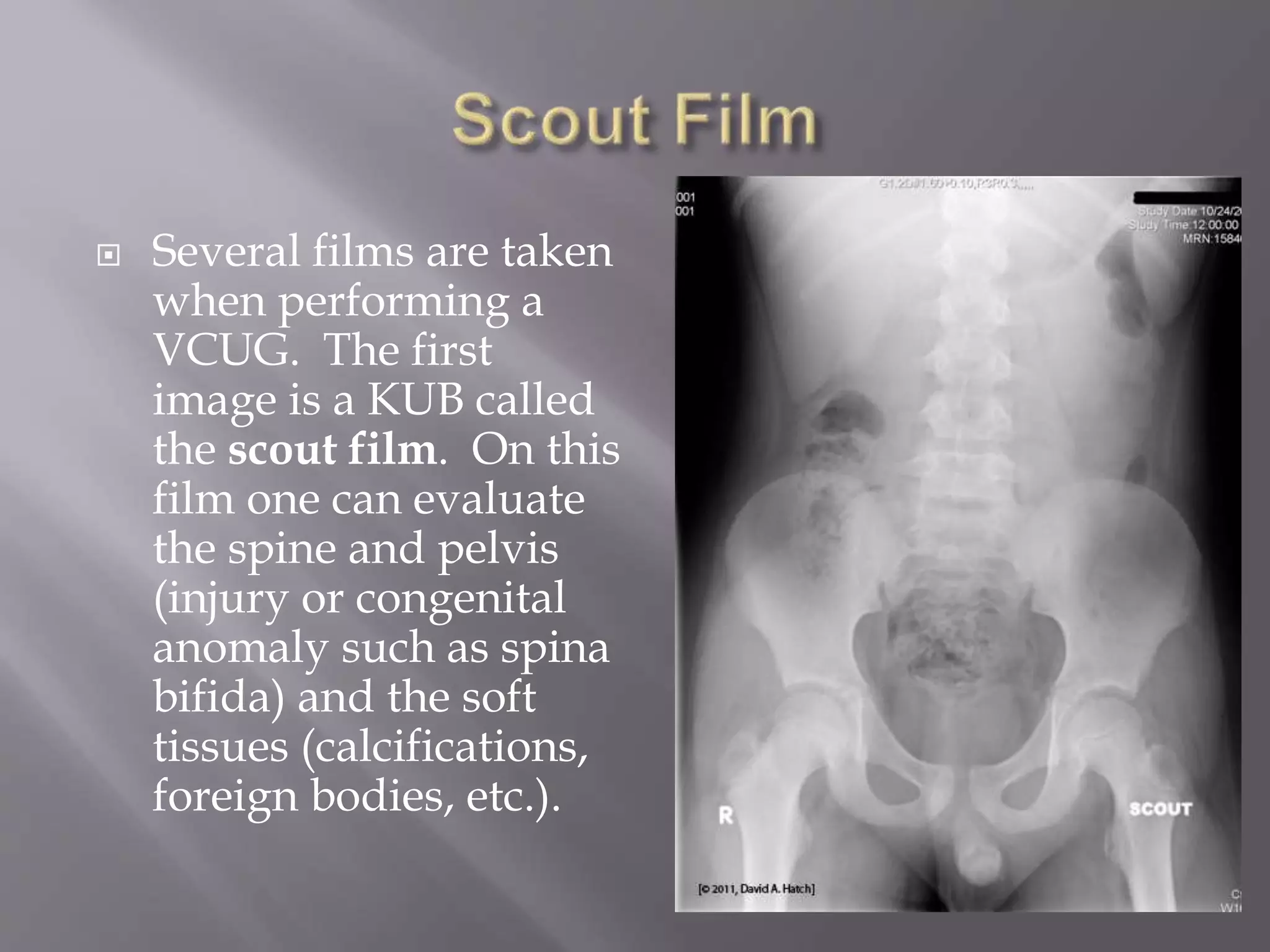 MCU- Micturating cysto-urethrogram | PPTX