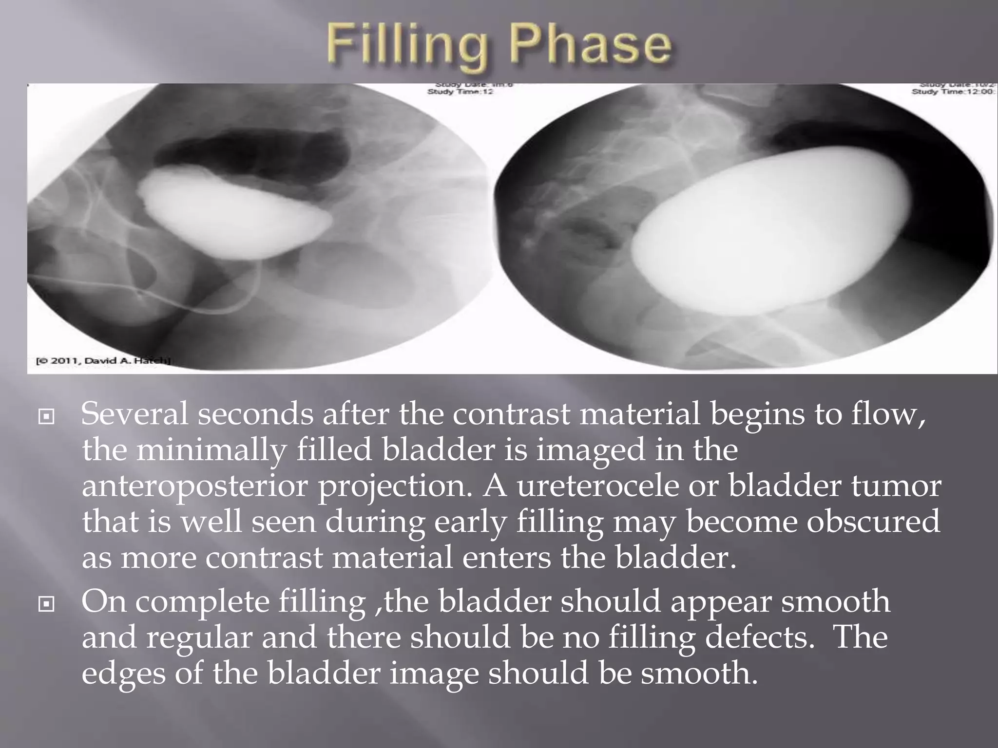 MCU- Micturating cysto-urethrogram | PPTX