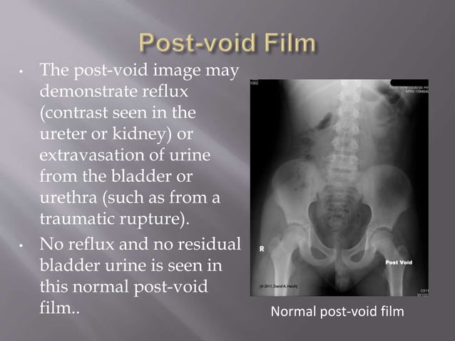 MCU- Micturating cysto-urethrogram | PPTX